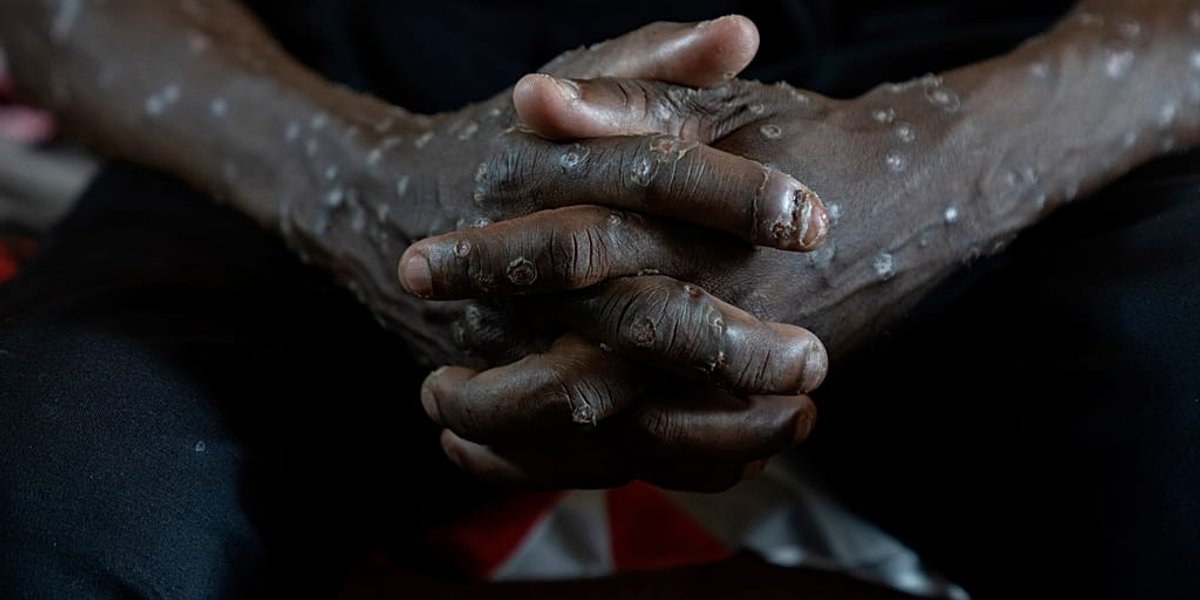 Interlinked Outbreaks: The 2026 Cascade of Global Health Crises | The ...
